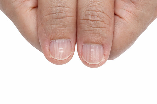 Witte Vlekken op Nagels: Prevent Witte Vlekjes | Supplend