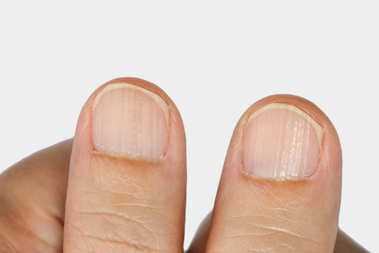 Strepen op nagels of geribbelde nagels? Dít kun je doen